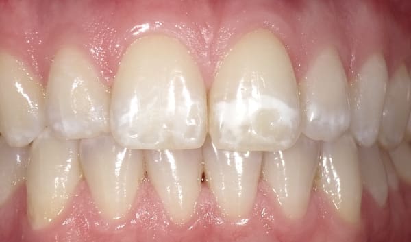 ICON Treatment for white spots | Oviedo Family & Cosmetic Dentistry